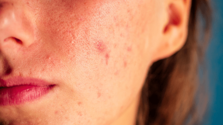 Top 3 des solutions pour soigner naturellement les boutons sur le visage
