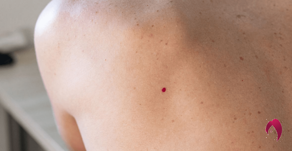 Vous avez un petit point rouge sur la peau qui ne part pas