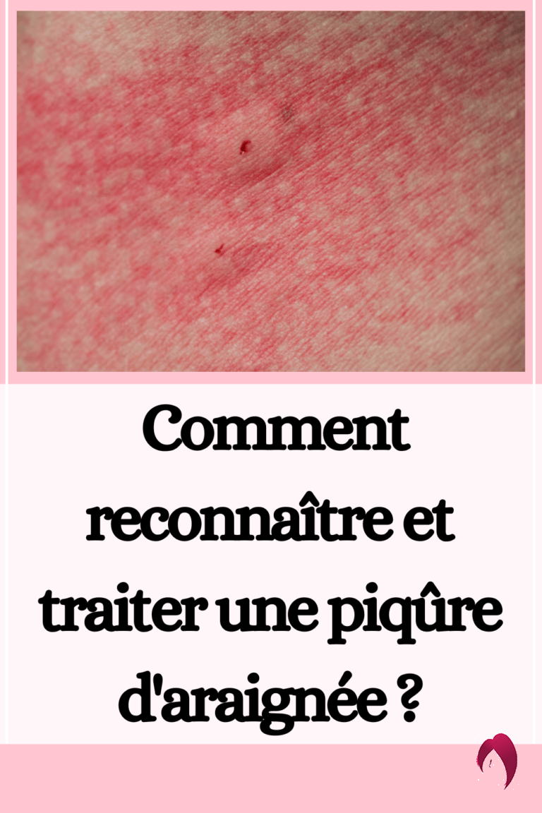 Comment reconnaître et traiter une piqûre d'araignée