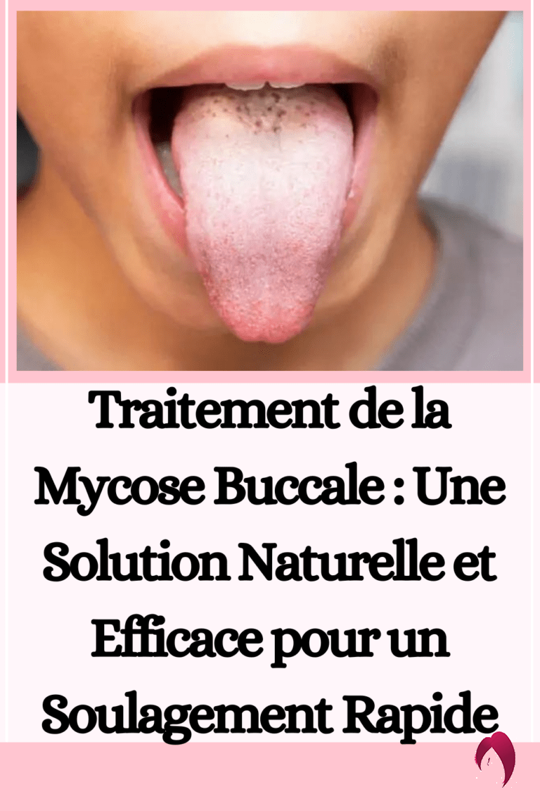 Traitement de la Mycose Buccale : Une Solution Naturelle