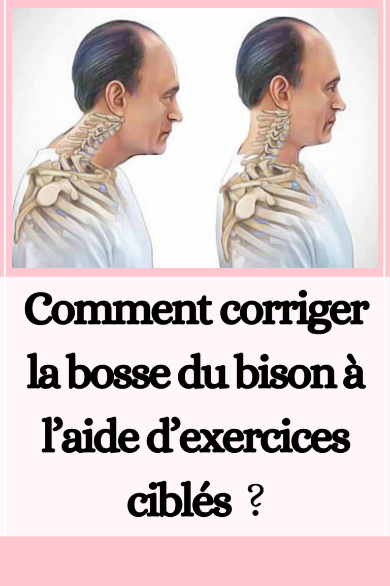 Comment corriger la bosse du bison à l’aide d’exercices ciblés